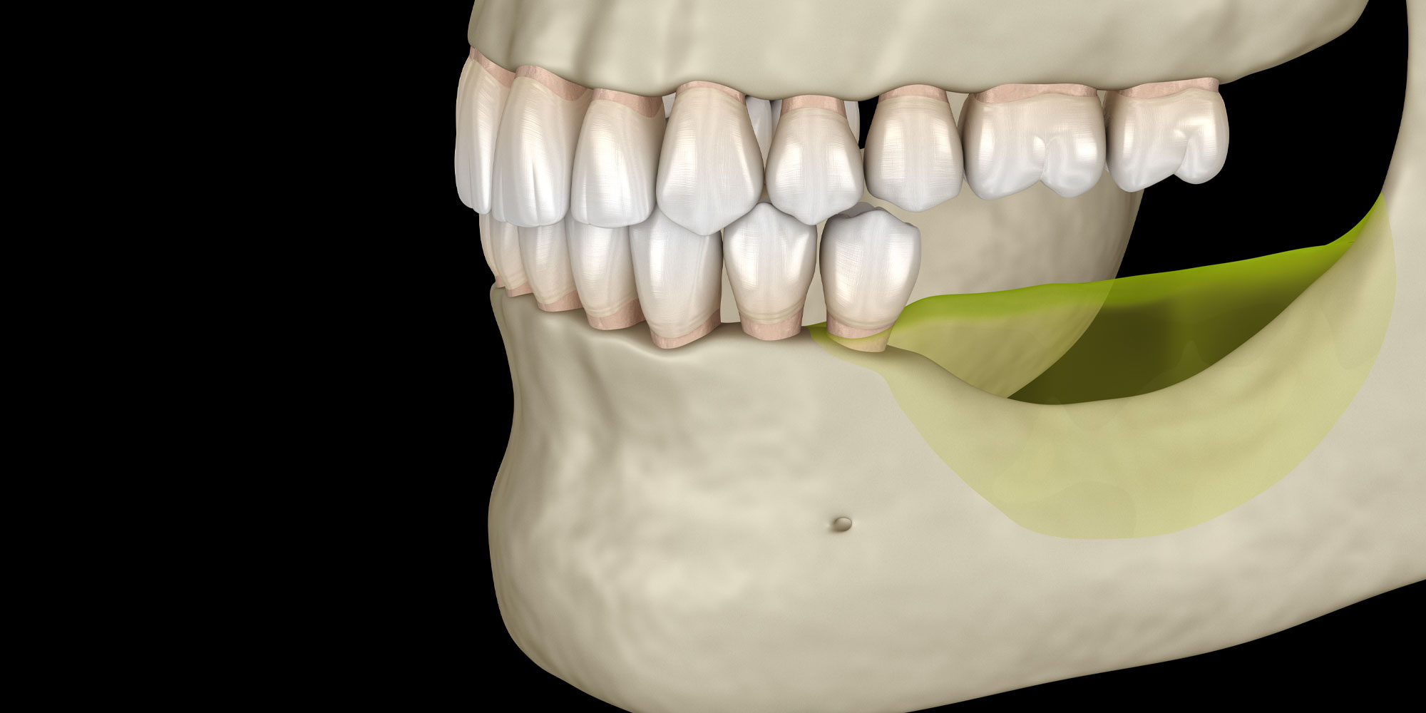 Full Mouth Dental Implants | Middletown, NY | Teeth Replacement